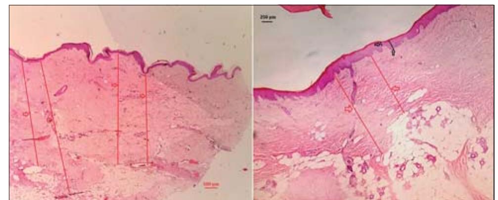 Figure 3 - from Measurement of epidermis, dermis, and total