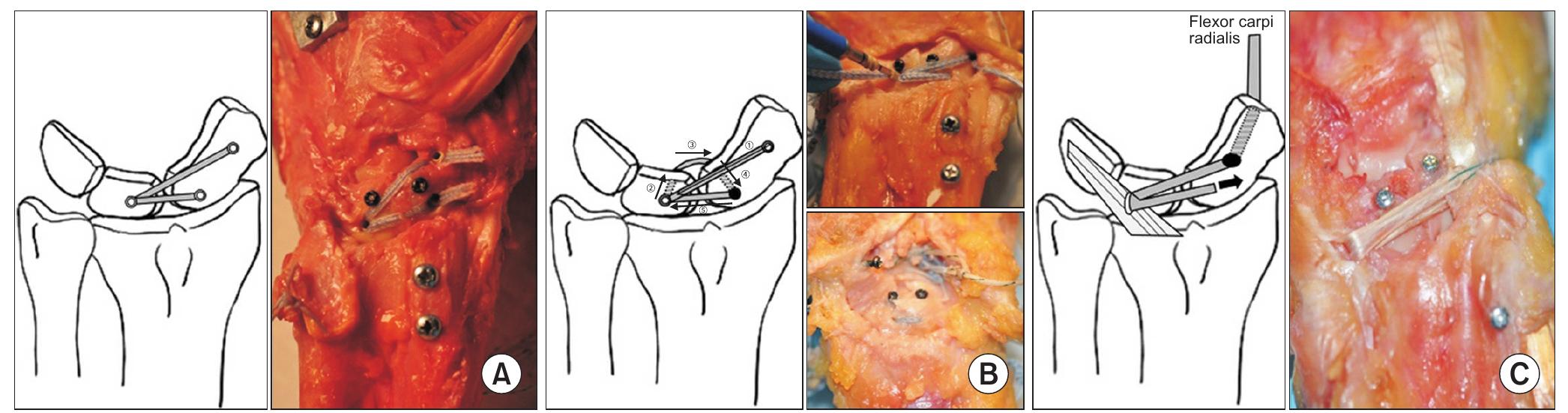 Methods of scapholunate interosseous ligament (slil)