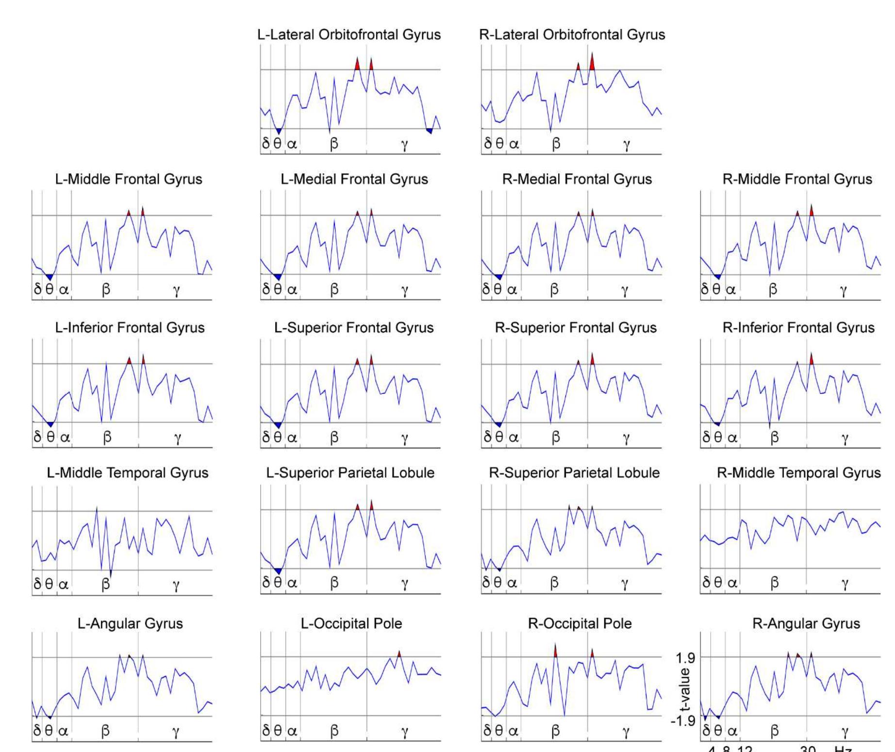 Gyri and the left occipital pole) and an overall increased