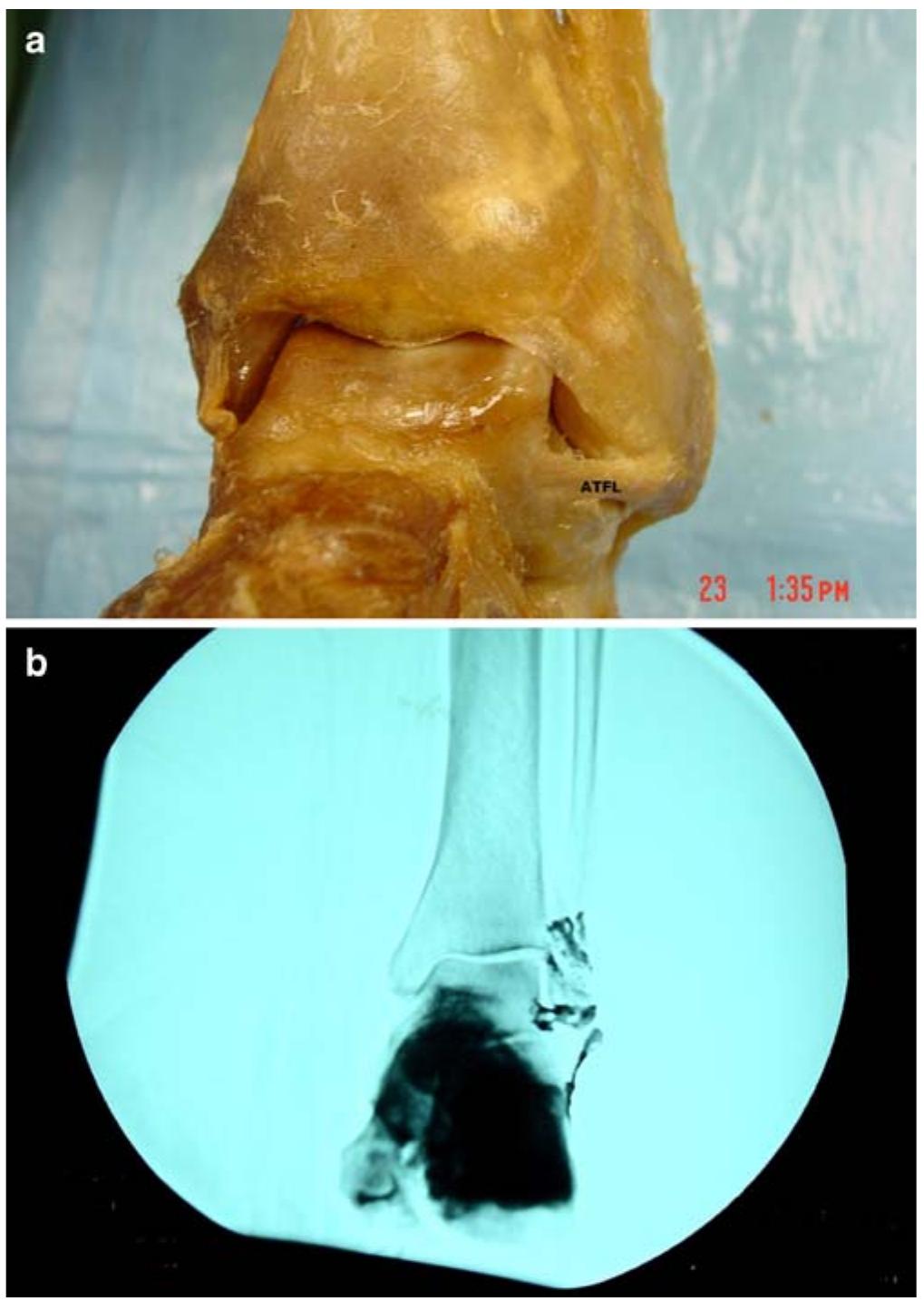 A anterior aspect of the ankle joint. atfl anterior