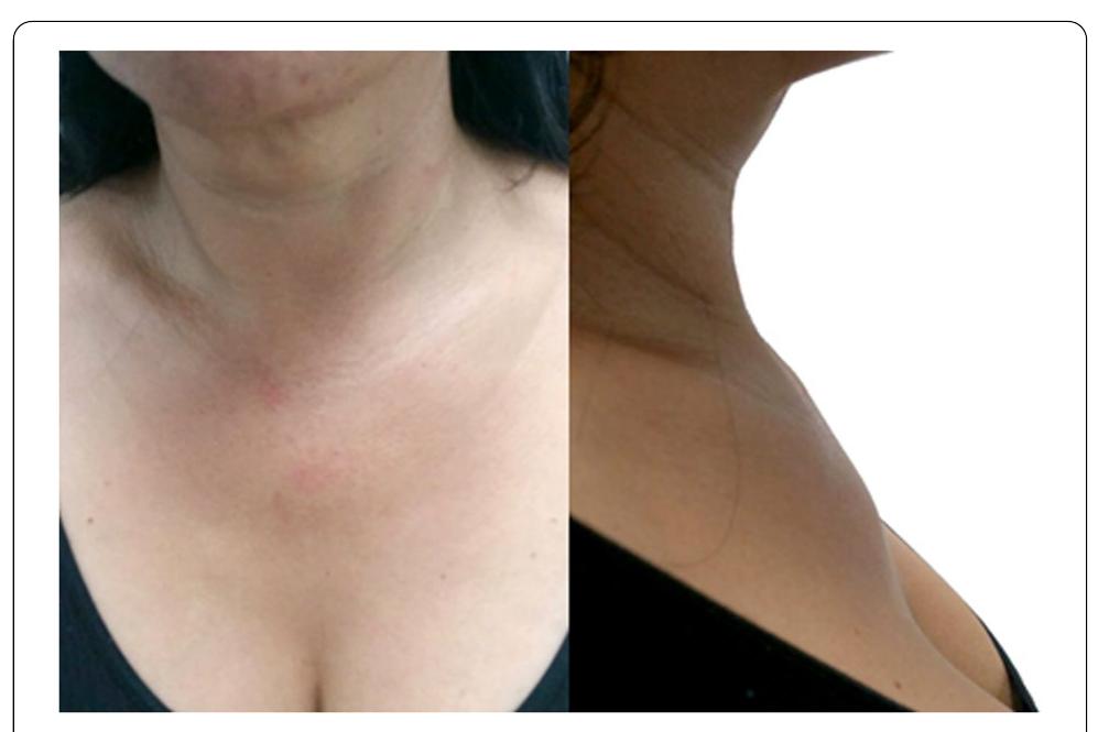 Swelling of the sternoclavicular region in a 47 year-old