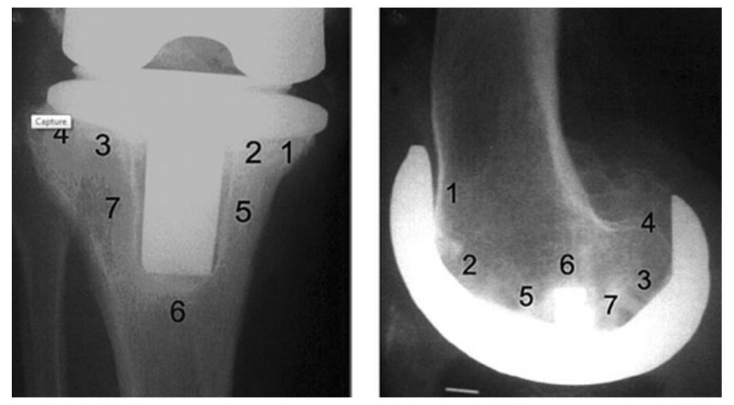 Septic loosening fig. 8 different cement zones on femoral