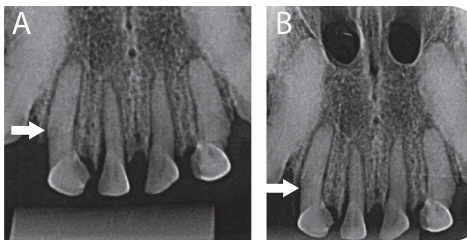 Figure 3 - Diagnosis of alveolar and root fractures: an in