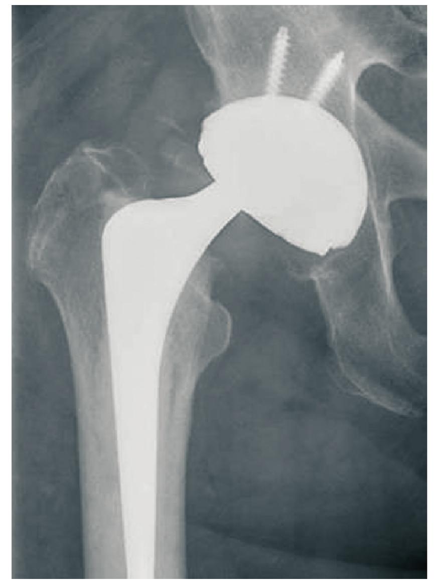 Intra prosthetic dislocation - femoral head is eccentric in