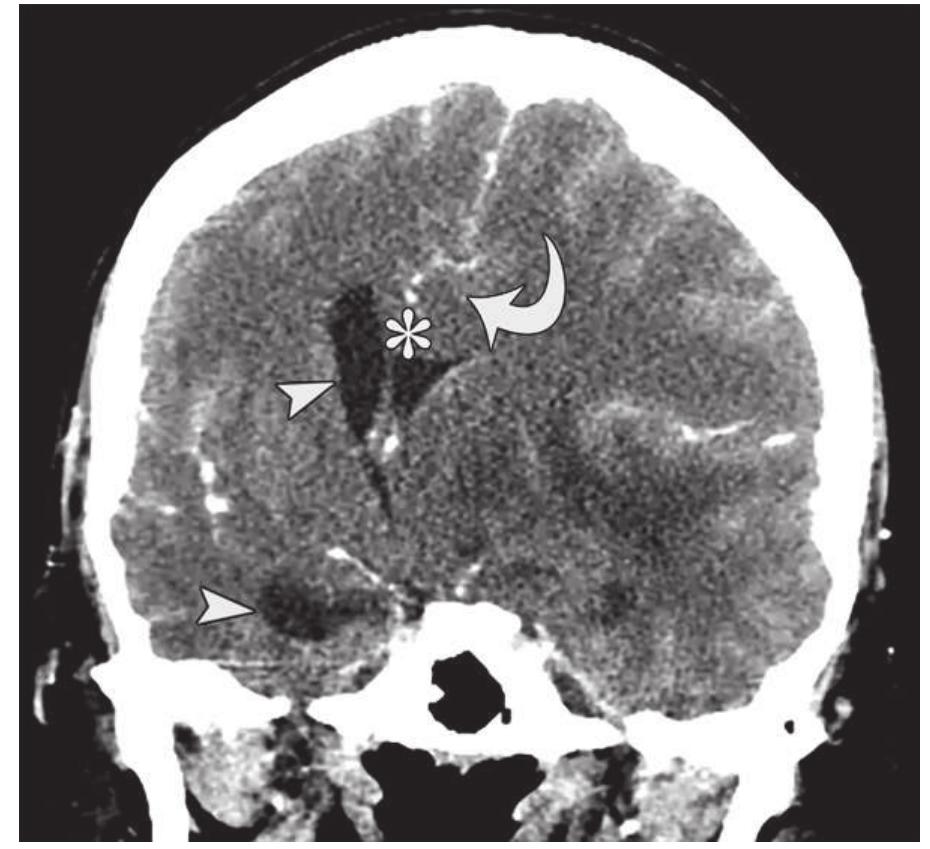 Figure 6 - Types of Cerebral Herniation and Their Imaging