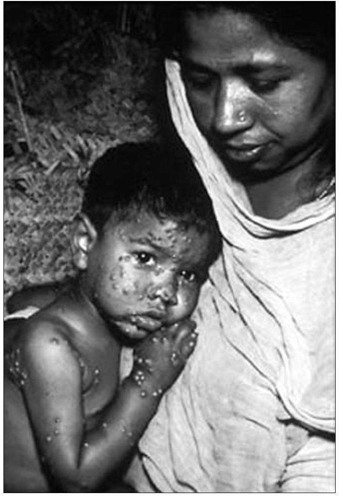 Smallpox in india, 1970s. photo courtesy of the world health