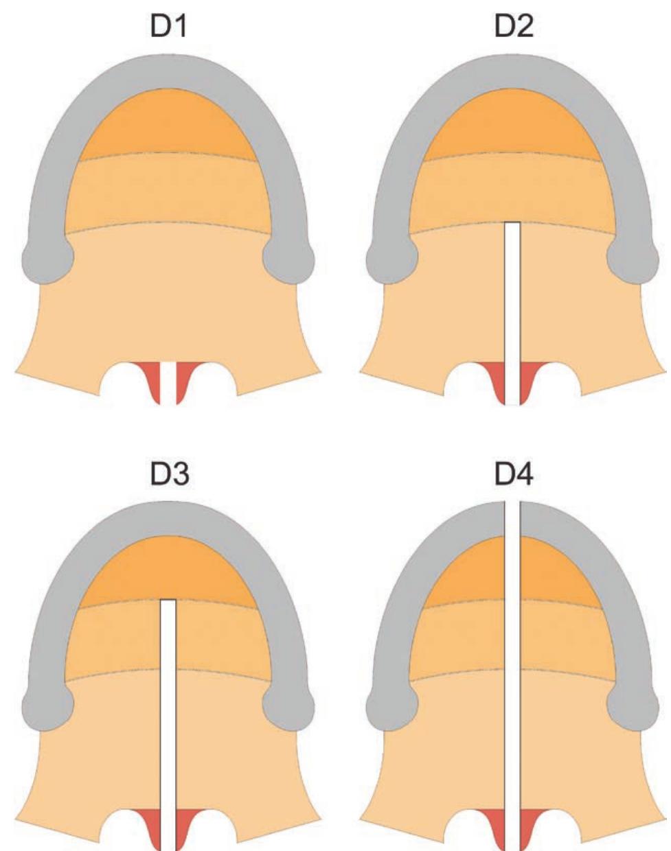 Schematic diagram showing the different types of dehiscence.