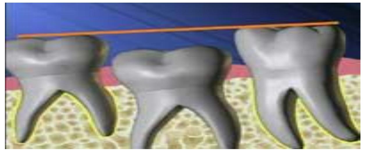 Figure 4 - Delayed Tooth Eruption