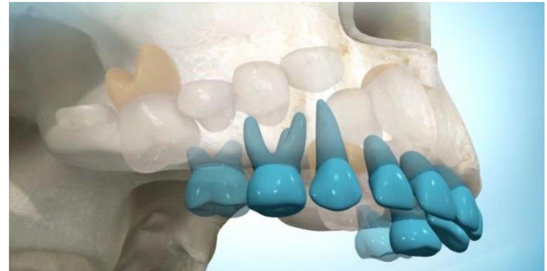 Figure 7 - Delayed Tooth Eruption