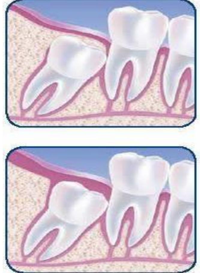 Figure 12 - Delayed Tooth Eruption