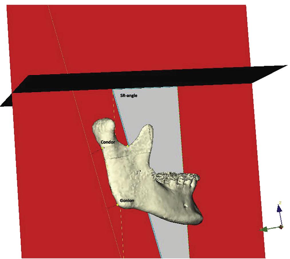 Sagittal ramus angle (sr angle). sagittal view of the 3d