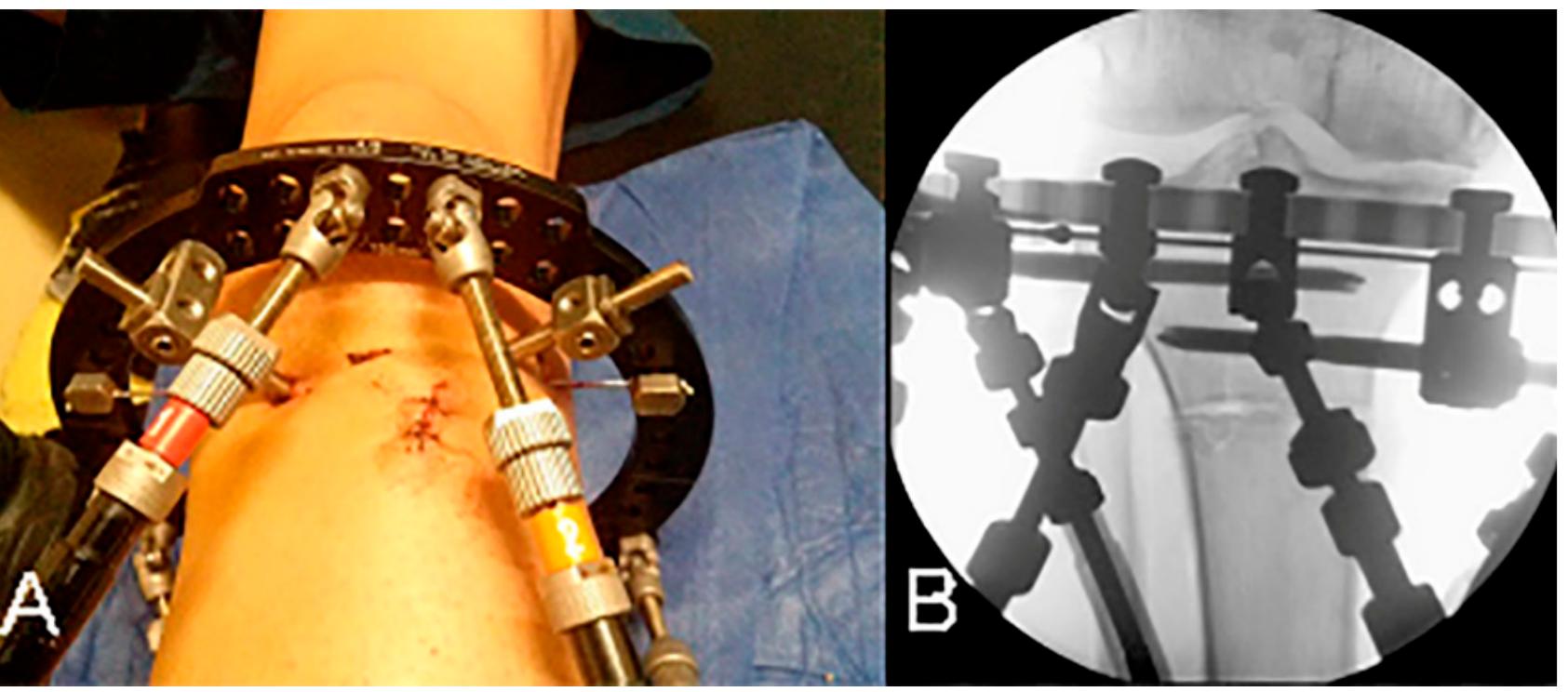 (a) open-wedge high tibial osteotomy performed with a small