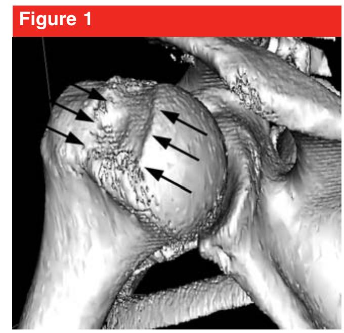 (PDF) The Hill-Sachs Lesion: Diagnosis, Classification, and Management