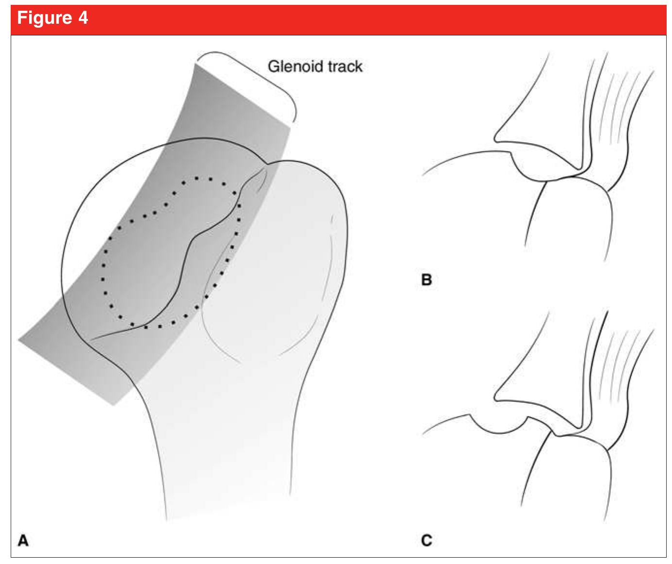 (PDF) The Hill-Sachs Lesion: Diagnosis, Classification, and Management