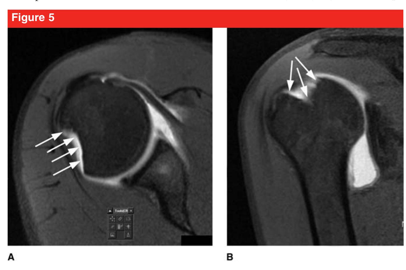(PDF) The Hill-Sachs Lesion: Diagnosis, Classification, and Management