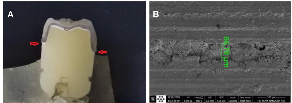 Cross-sectional view of the cemented crown and marginal