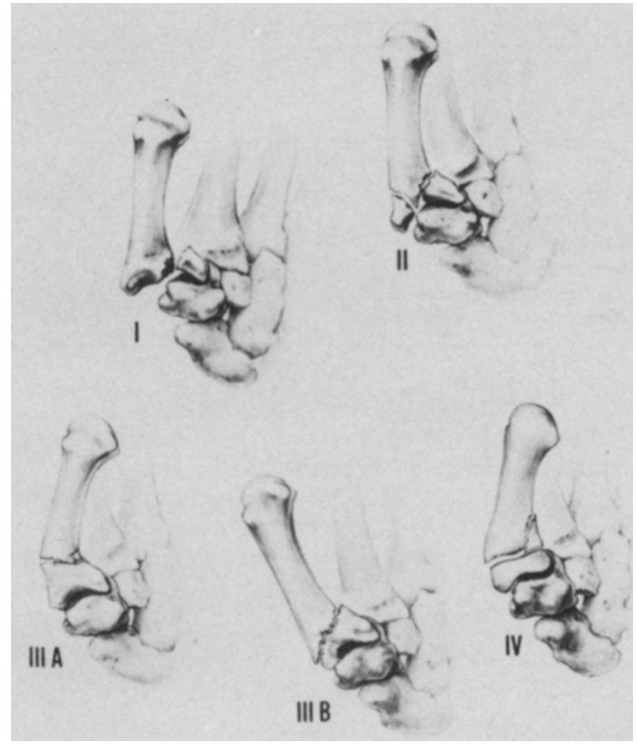 Classification of first metacarpal base fractures (reprinted