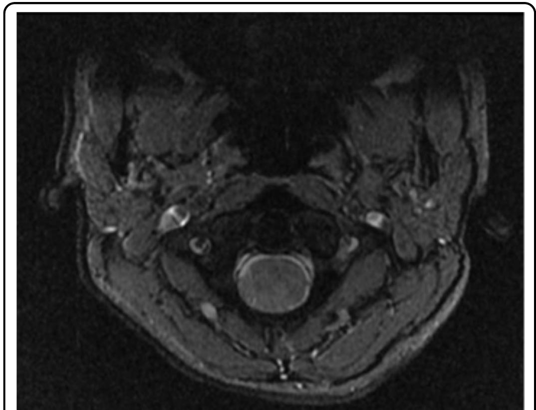 Axial t1w shows tonsillar descend with anterior brainstem