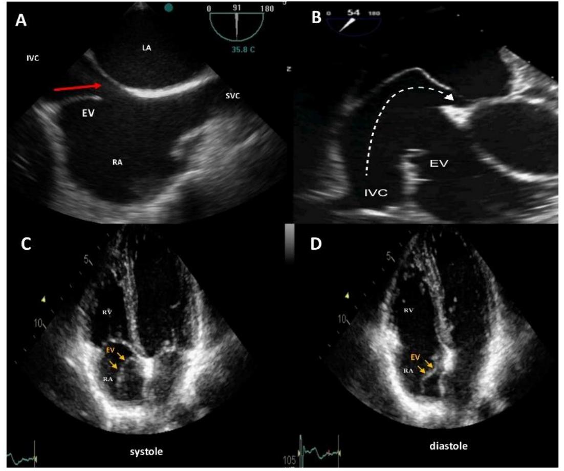 Two-dimensional transesophageal (a-b) echocardiography mid-