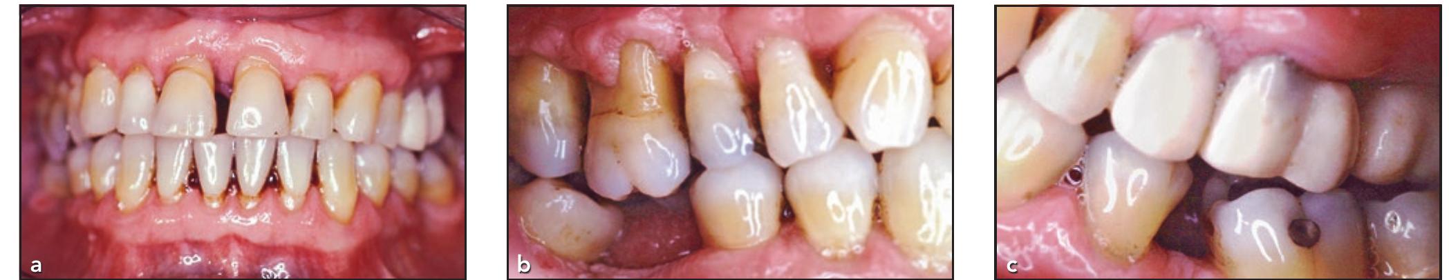 (a) buccal and (b and c) lateral views of orthodontic
