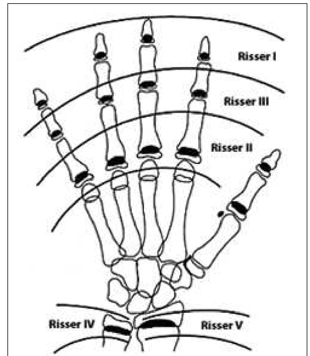 Risser sign assessment of wrist and hand maturation.
