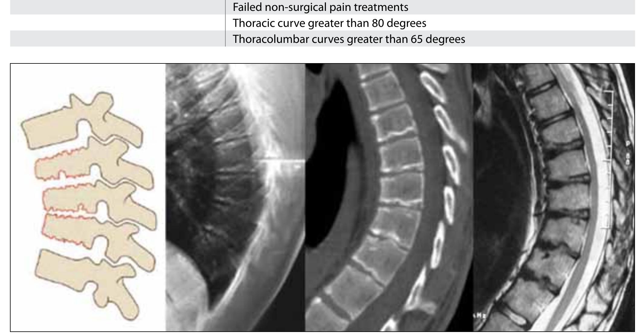 Radiological findings of scheuermann’s disease: endplate