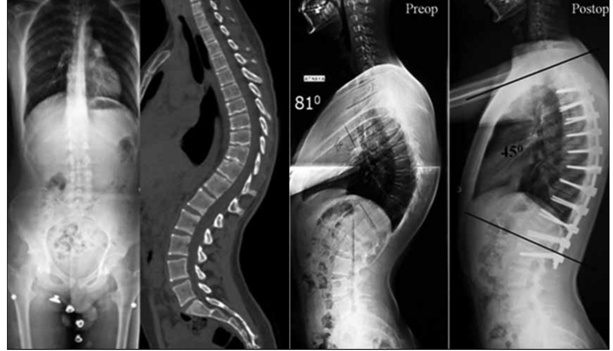 16-year old male patient with scheuermann kyphosis