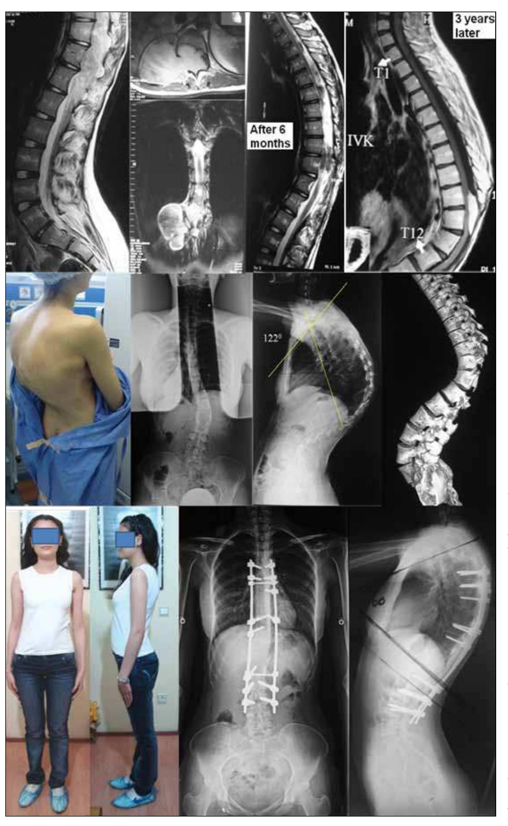 Figure 4 - Kyphosis : Diagnosis , Classification and