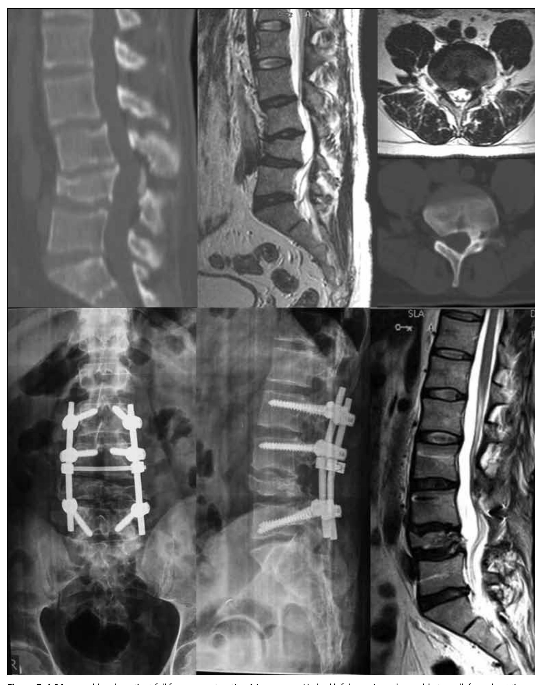 Figure 7 - Kyphosis : Diagnosis , Classification and