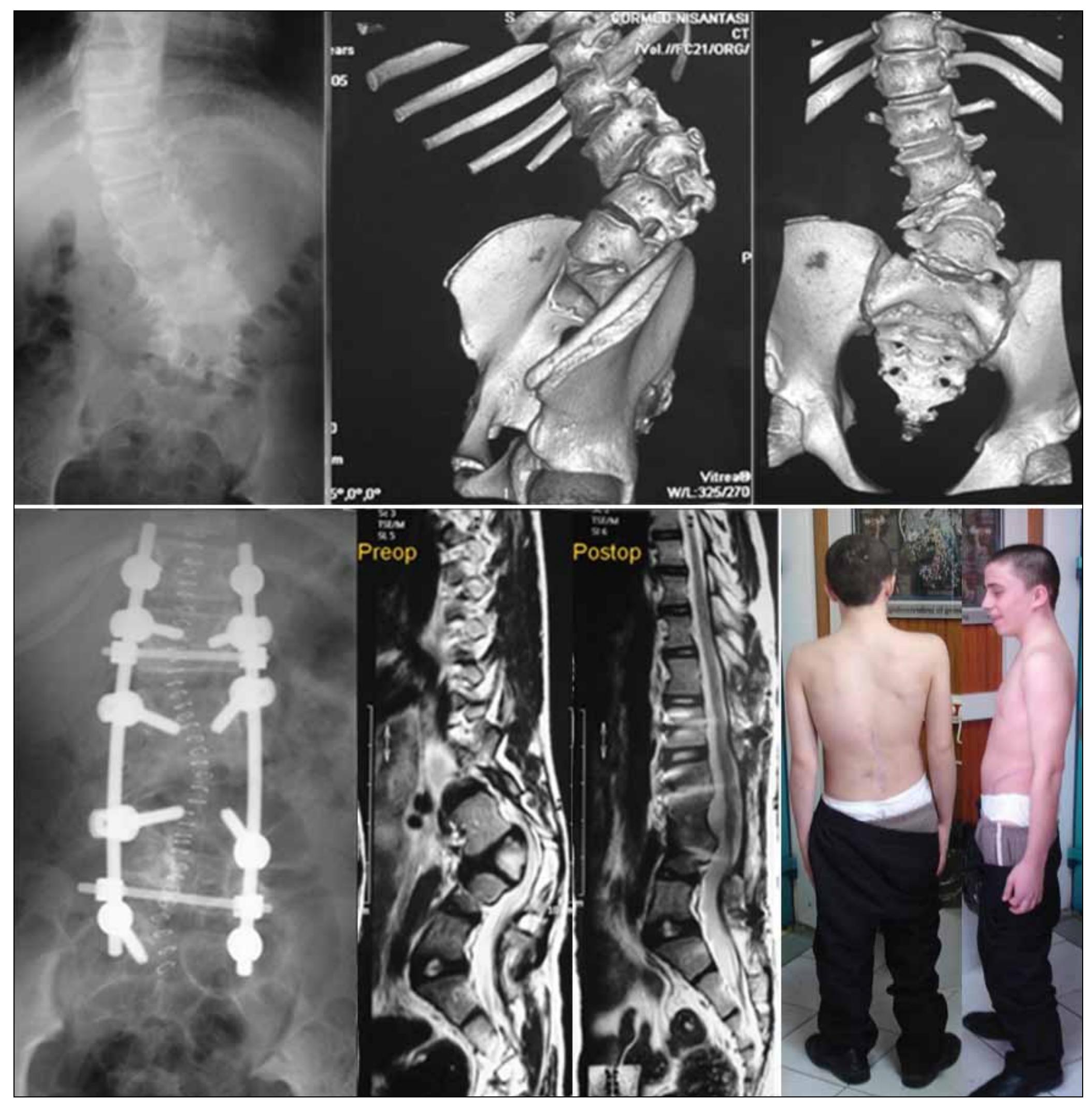 A 14-year-old male patient with congenital kyphosis. severe
