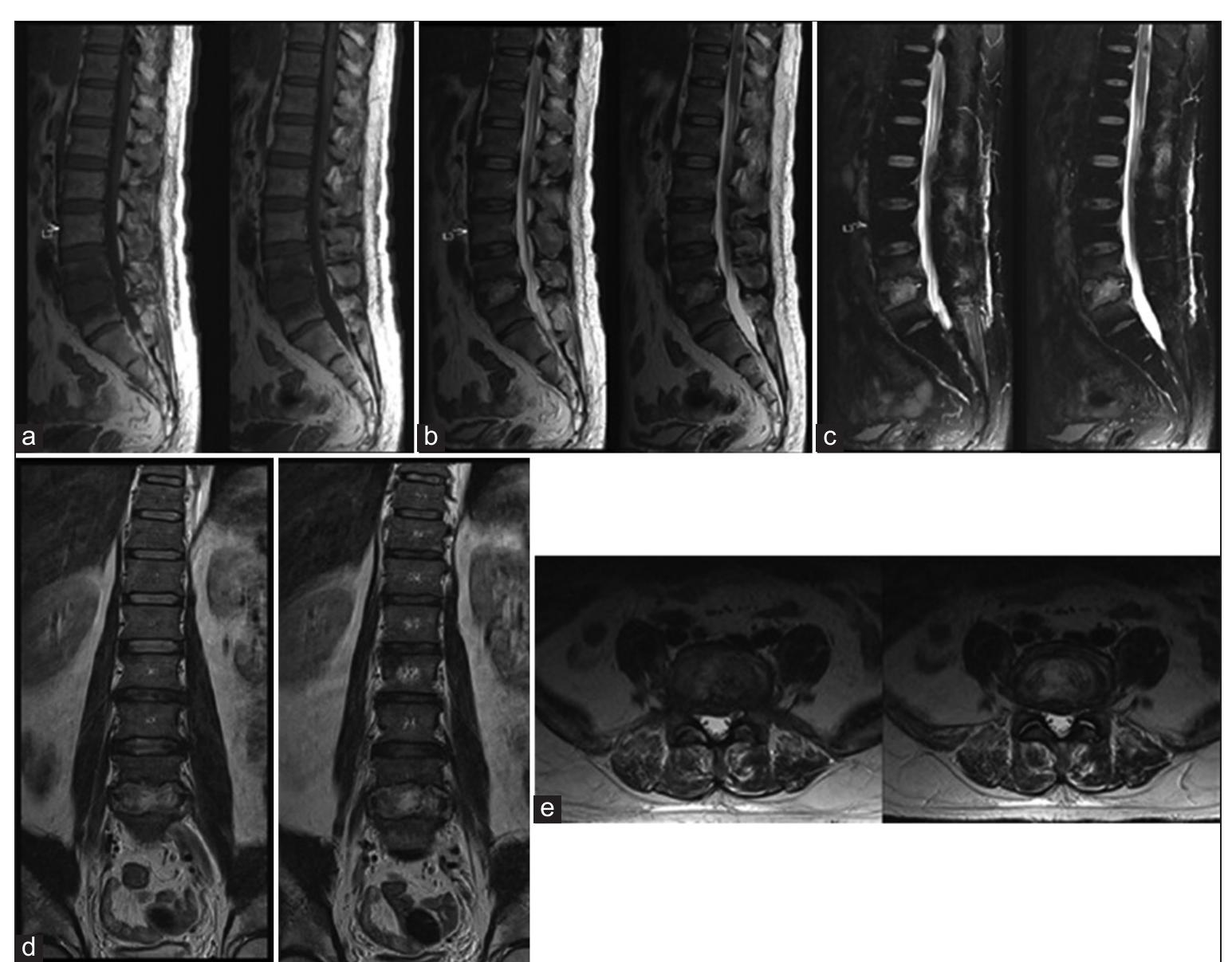 Thoracolumbar mri of spinal tb in 52-year-old male;