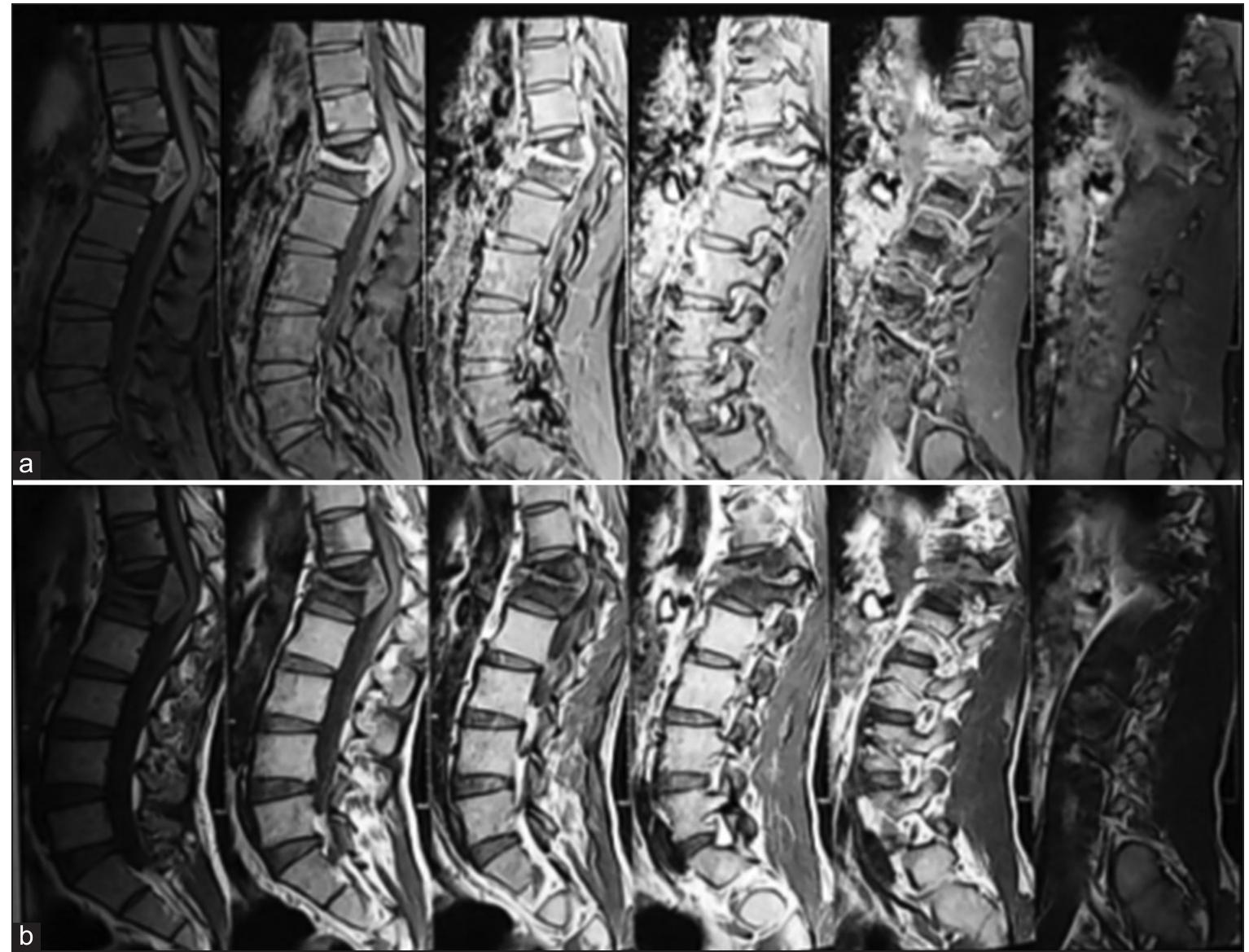(a-b) thoracolumbar mri in a 22-year-old male with spinal