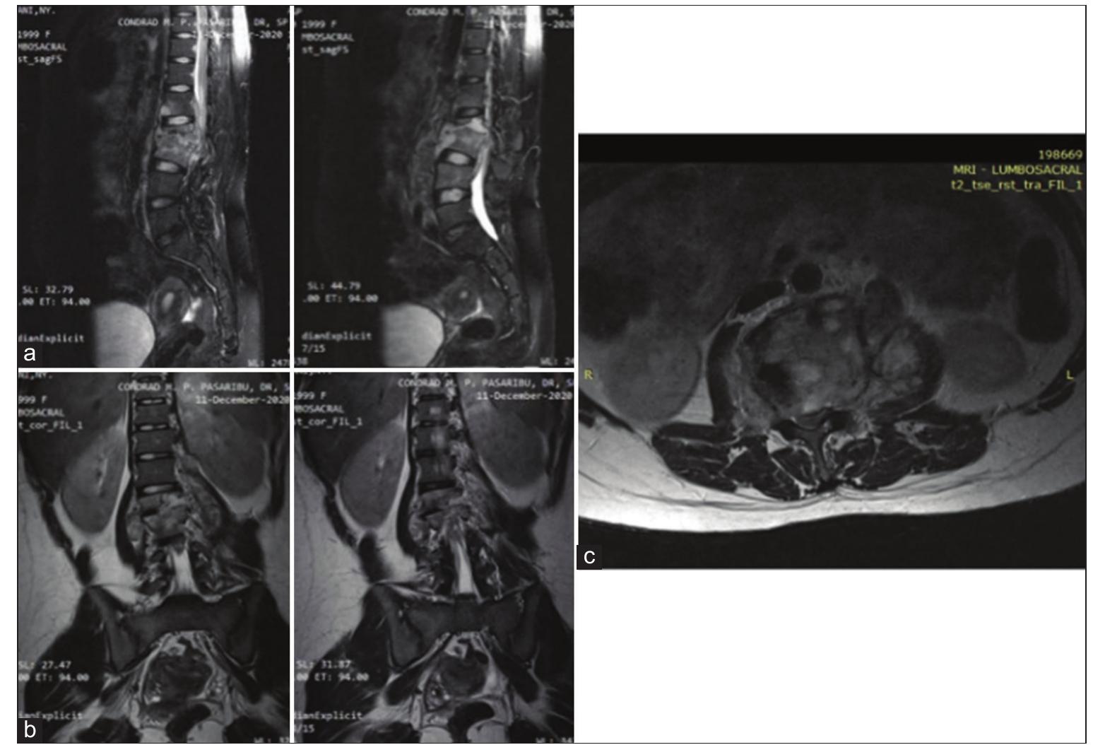 Thoracolumbar mri in a 21-year-old female with spinal tb.