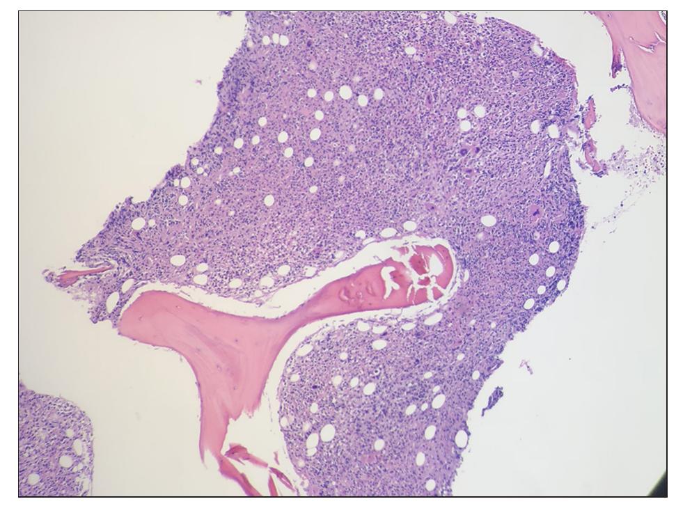 Bone marrow core biopsy (hematoxylin and eosin stain, 100x).