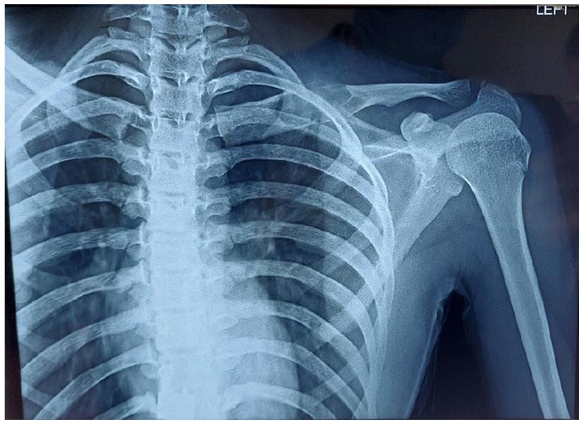 Pre-operative plain radiograph showing the lesion in the