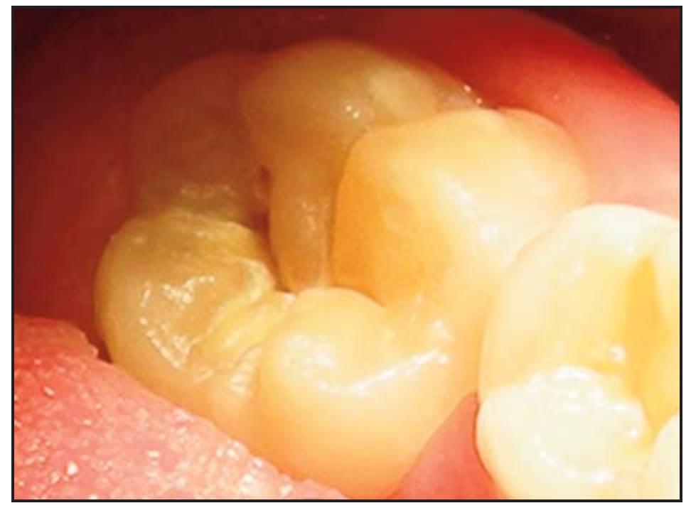 Clinical occlusal view of mandibular first permanent molar.