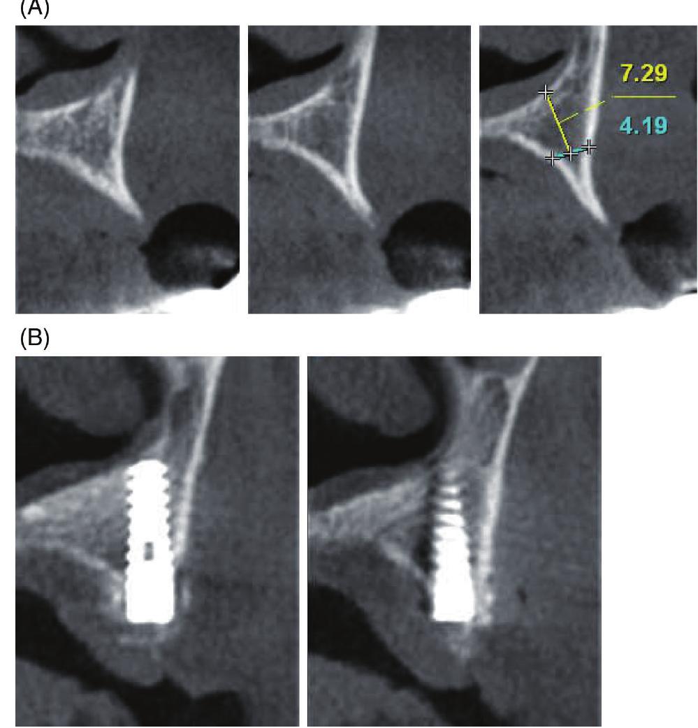 Ct scan of the anterior maxillary area before (a) and