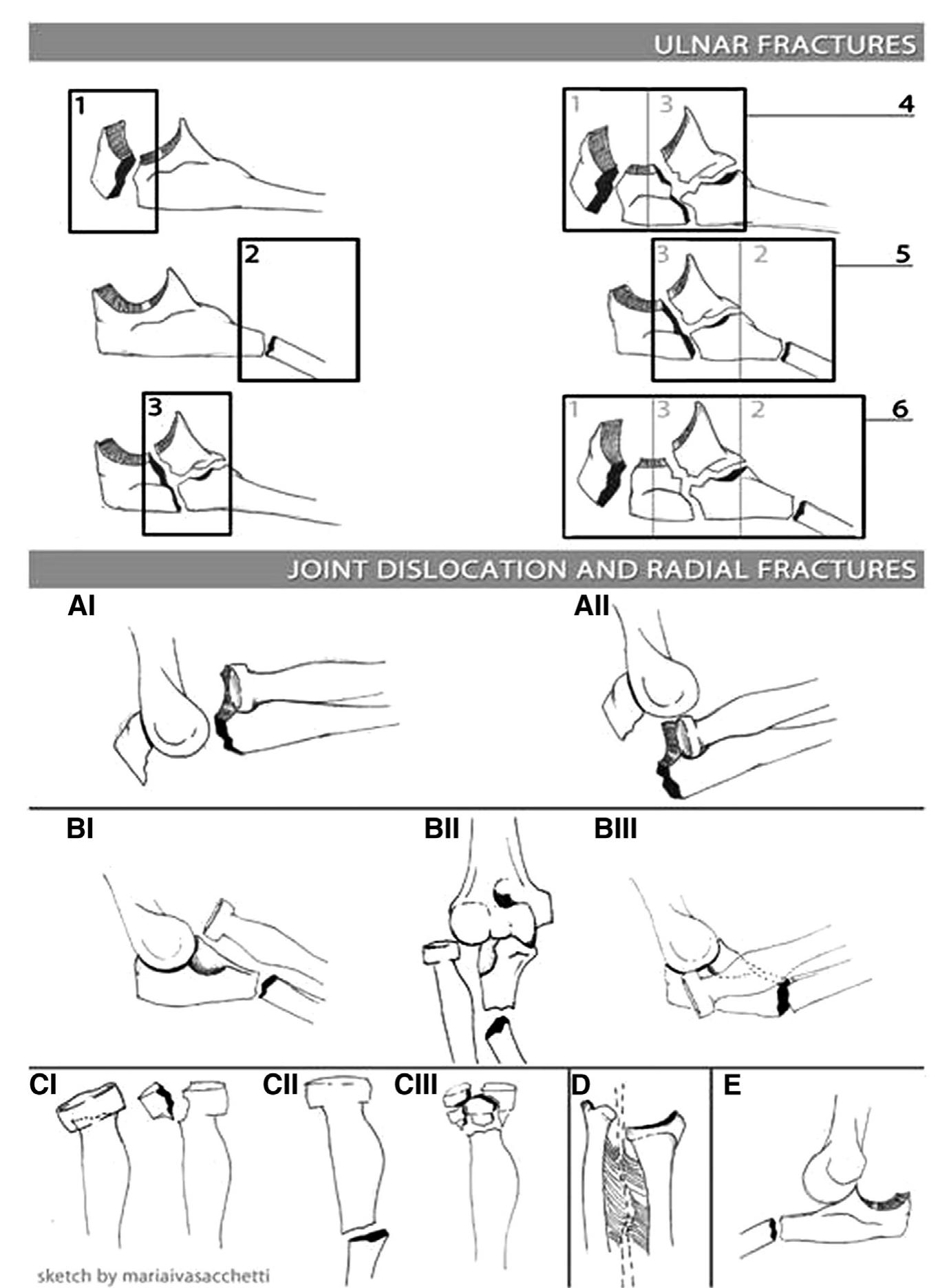 Purccs scheme. ulnar fracture type is labeled with numbers