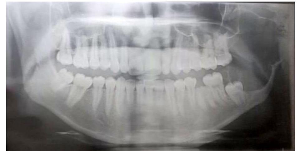 Orthopantomograph revealing well defined radiolucency