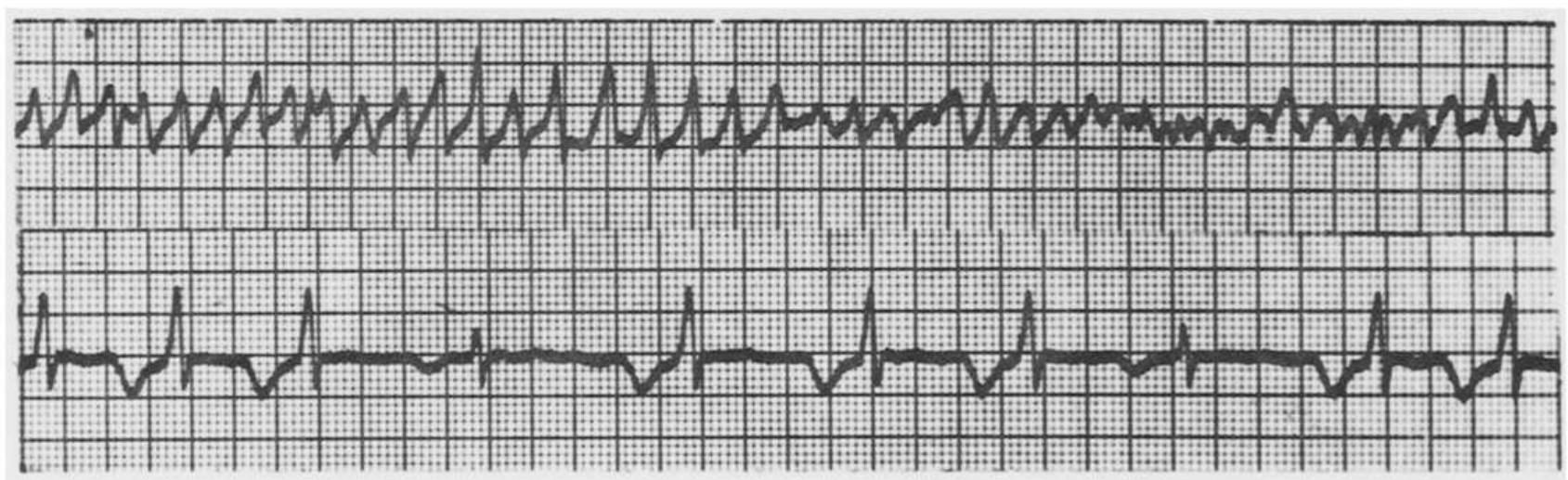 Lead ii (top) with simultaneous intra-atrial electrogram