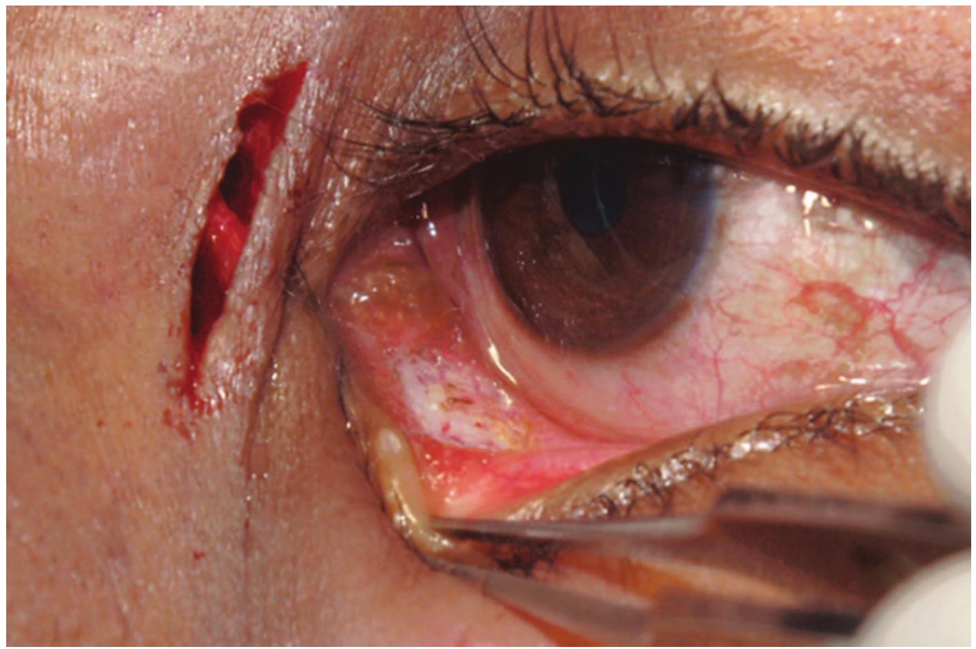 Medial conjunctivoplasty. a diamond excision of conjunctiva