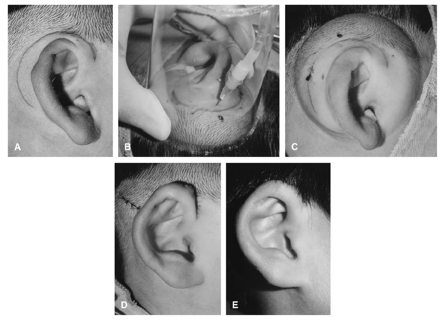 Figure 79 - Management of Fronto-Orbital Sphenoidal and