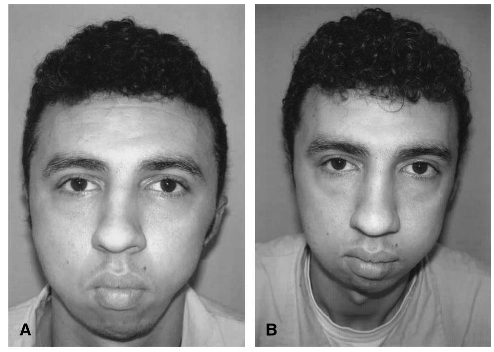 (a) mandibular contour deformity, more evident at the left