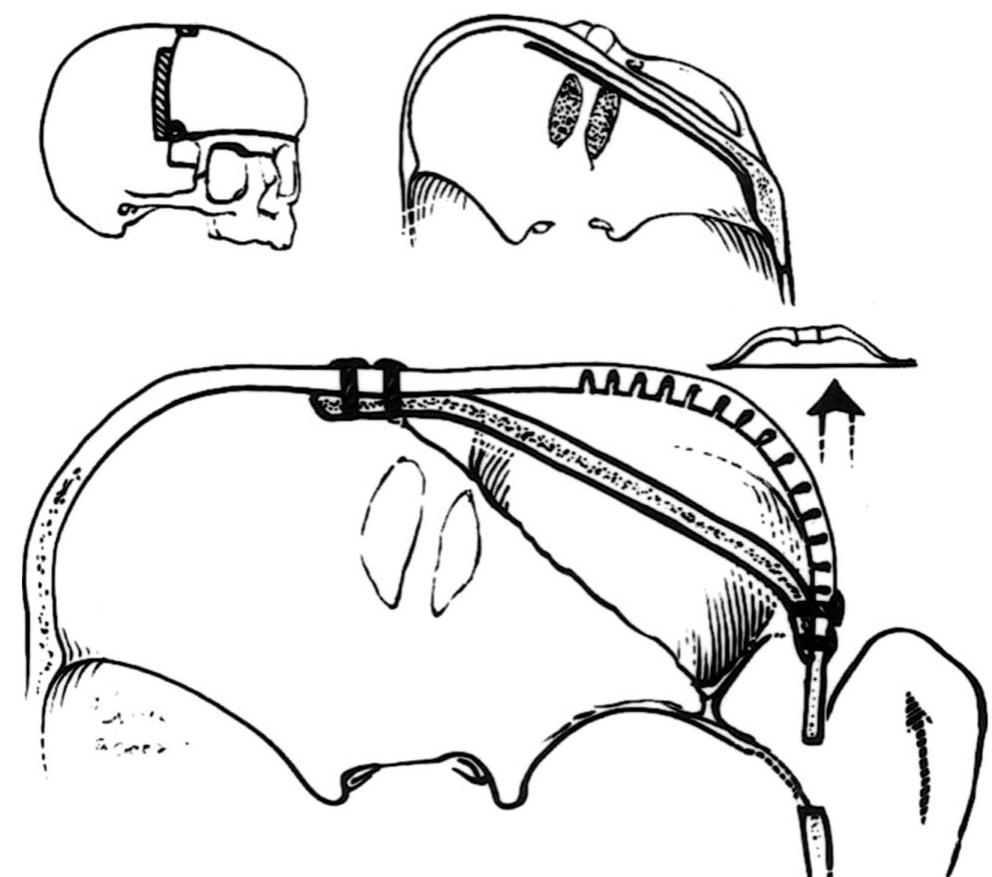 Figure 105 - Management of Fronto-Orbital Sphenoidal and