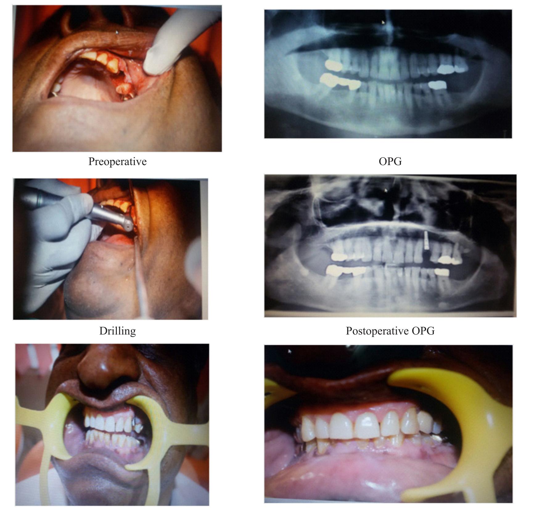 Crown fixation abutment placement post operative antibiotics