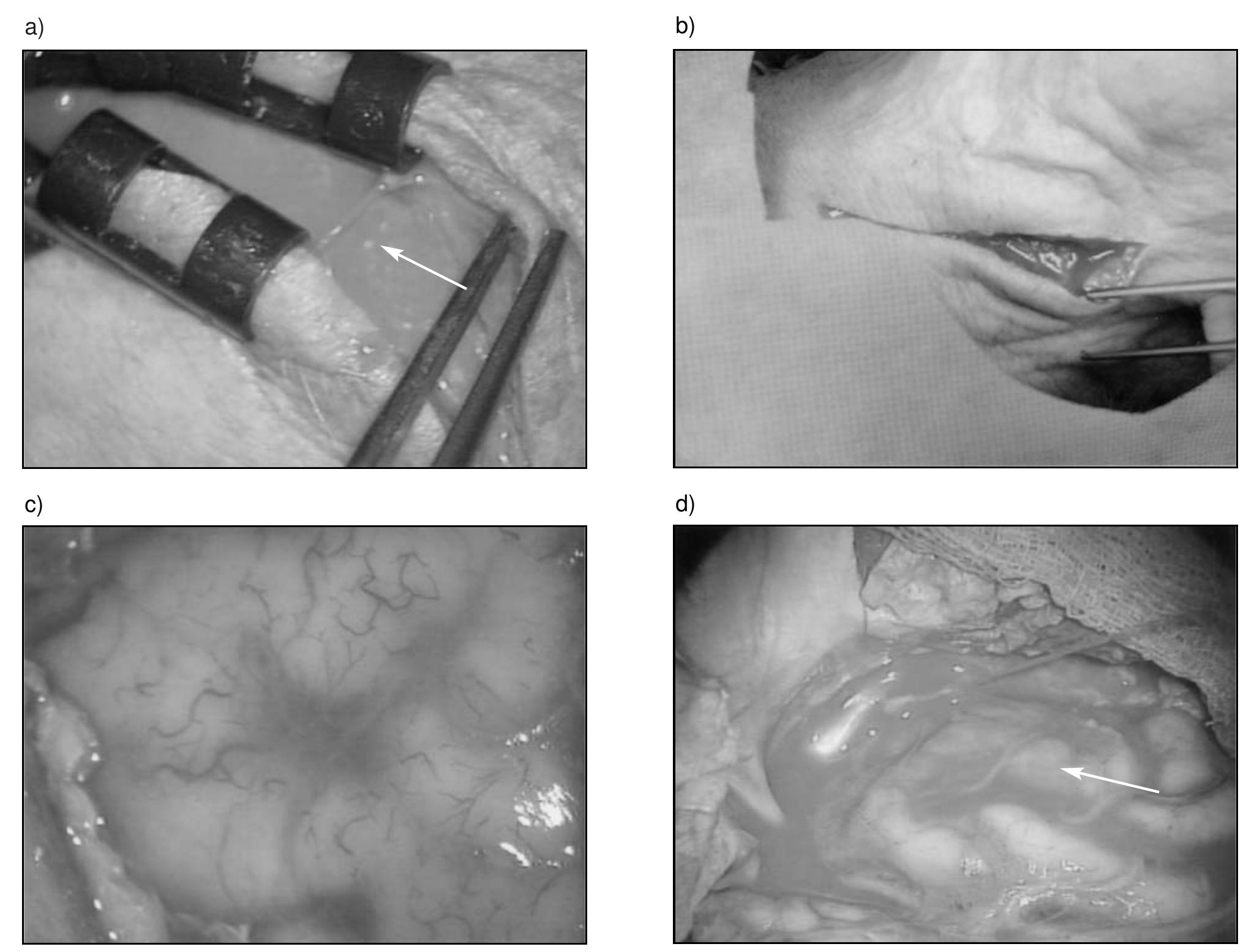 A) and b) skin incisions in the scalp and the neck; note the