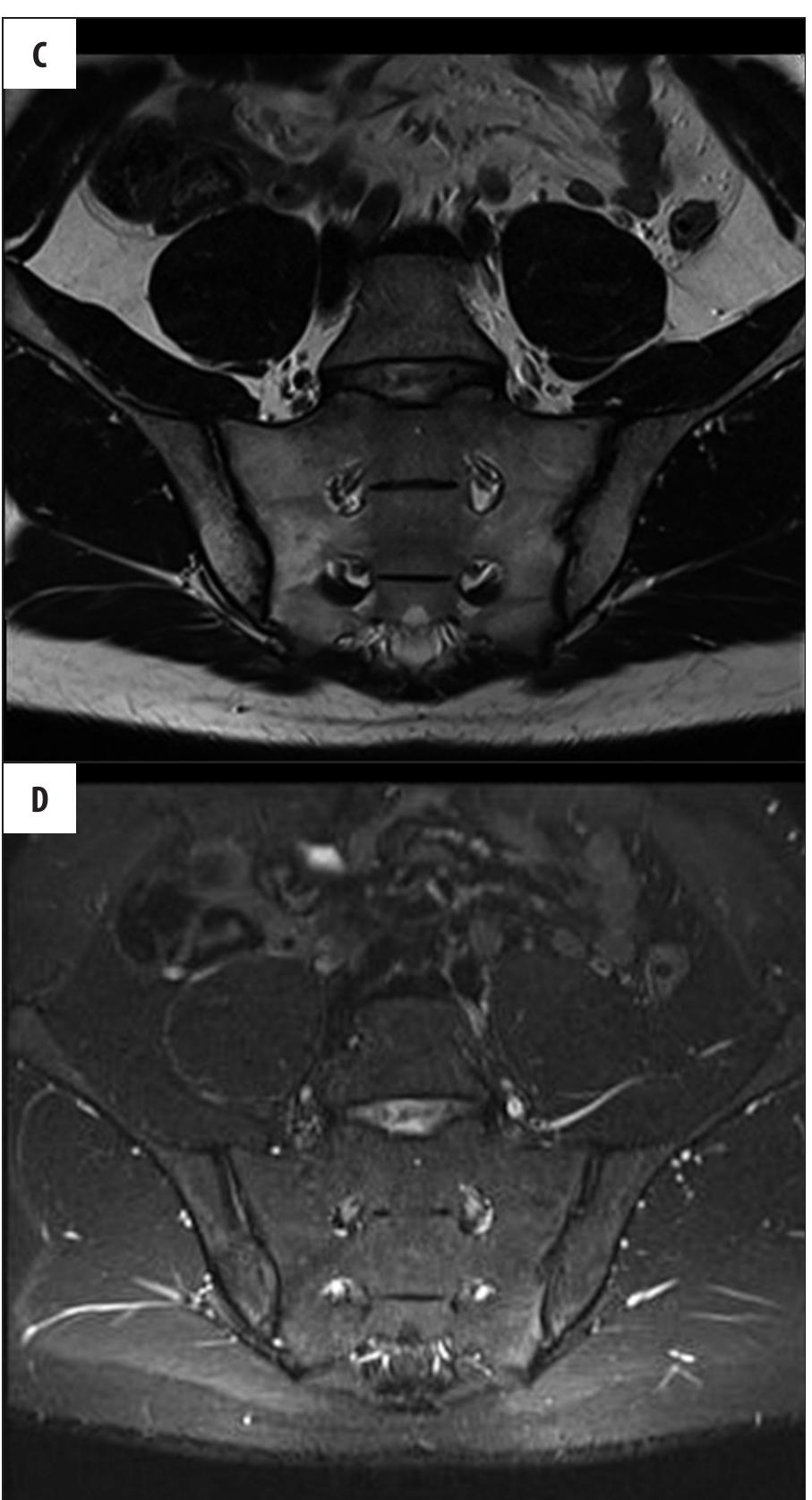 Igure 1. bilateral sacroiliitis grade | on radiograph (a);