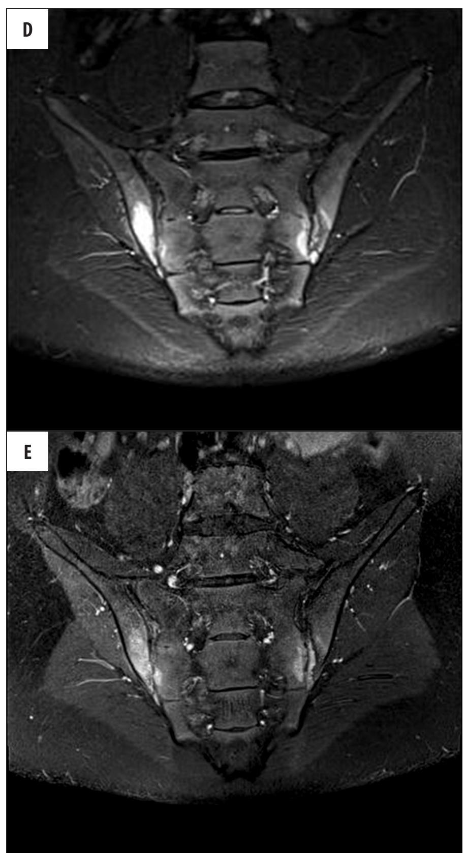 Figure 6 - Diagnostics of Sacroiliitis According to ASAS