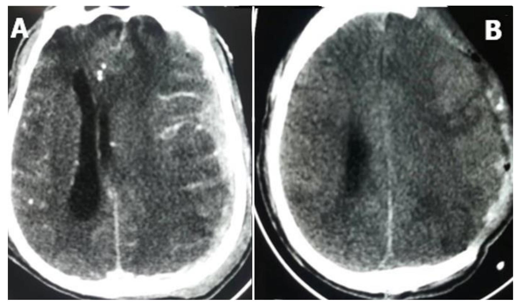 A) axial section brain ct scan showing acute subdural