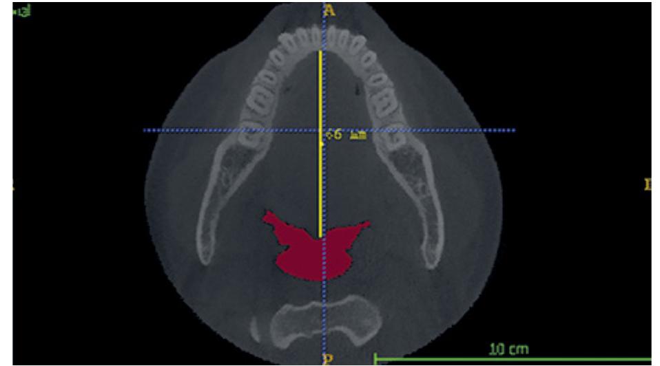 Figure 3 - Airway dimensions and mandibular position in